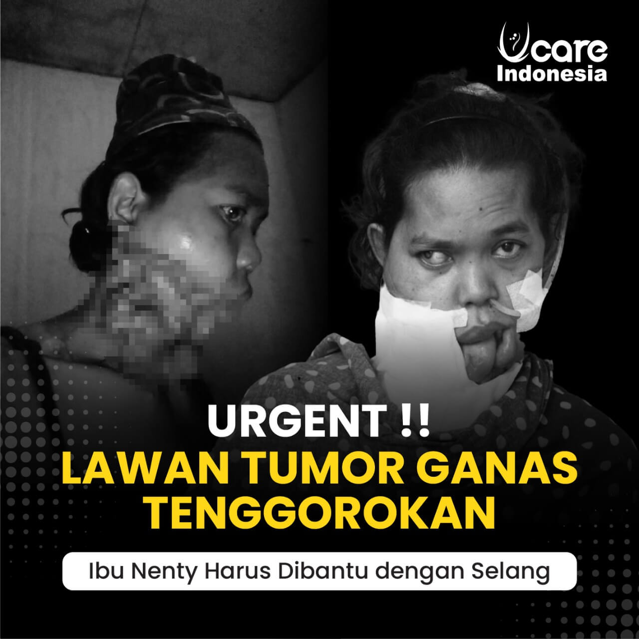 Lawan Tumor Ganas Tenggorokan, Ibu Nenty Harus Hidup dengan Selang ...